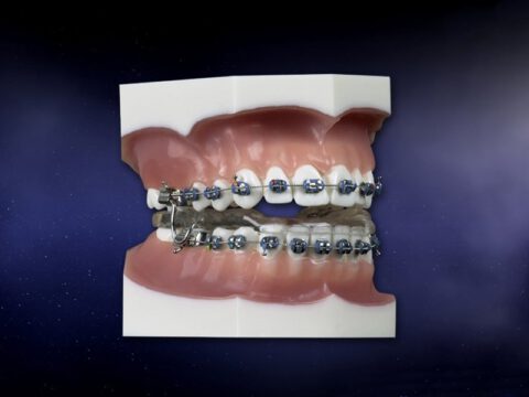 Beugels | Orthoheerenveen